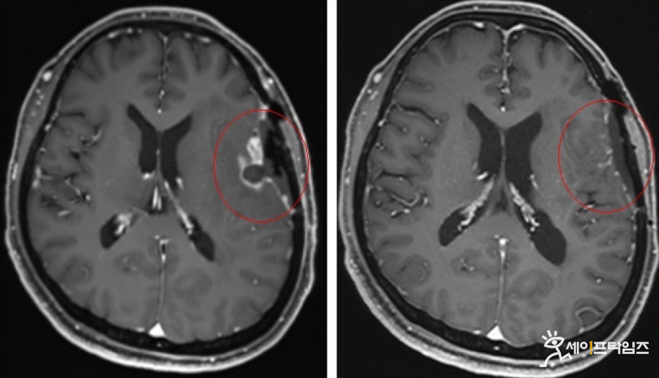 가천대 길병원 '꿈의 암 치료기' A-BNCT 안정성 입증 - 세이프타임즈
